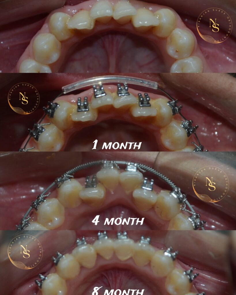 REGULAR BRACES - Smiles & Braces, Chikhali, PCMC
